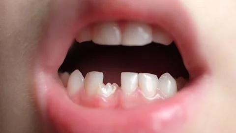 The teeth of a six-year-old child, a cro... | Stock Video | Pond5
