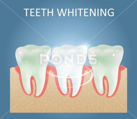 Teeth whitening vector medical poster design template ~ Clip Art #118257187