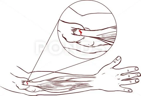 Tennis elbow - tear in the common extensor tendon of the arm (black and ...