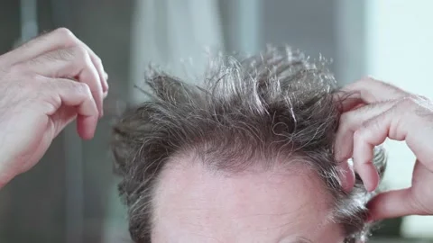 Thinning hair, the problem of hair loss ... | Stock Video | Pond5