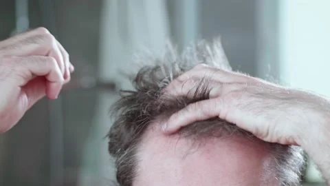 Thinning hair, the problem of hair loss ... | Stock Video | Pond5