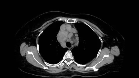 Thyroid cancer, chest CT scan | Stock Video | Pond5