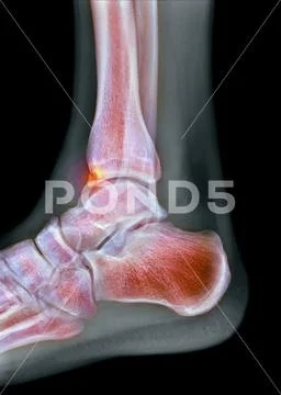 Tibial spur, X-ray ~ High Resolution & Quality #75563693
