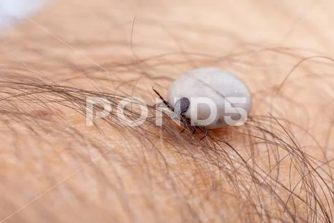 Tick on human hand Tick (Ixodes ricinus) on human skin filled with ...