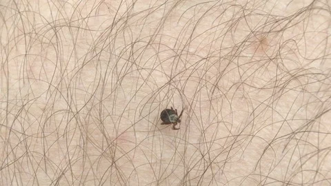 Tick on the human skin. Ornate sheep tic... | Stock Video | Pond5
