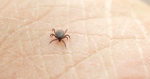 Tick walking on human skin - 4K video | Stock Video | Pond5