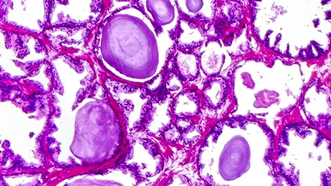 Enlarged Prostate Stock Video Footage | Royalty Free Enlarged Prostate ...