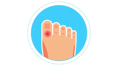 toe pain injury of foot in human body he... | Stock Video | Pond5