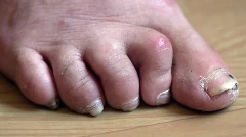 Crippled Stock Footage ~ Royalty Free Stock Videos | Pond5