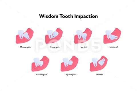 Tooth anatomy chart. Cross section. Wisdom teeth impaction: Royalty ...