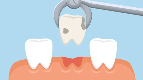 Tooth extraction dental animation. Recep... | Stock Video | Pond5