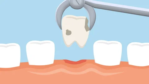Tooth extraction dental animation. Recep... | Stock Video | Pond5