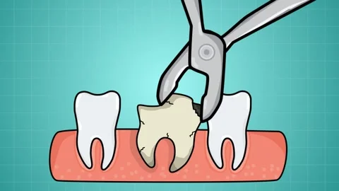 Tooth Extraction Dental Medical Animatio... | Stock Video | Pond5