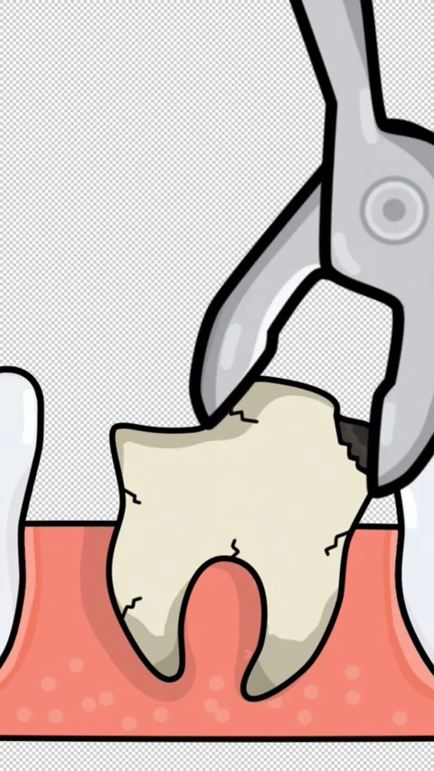 Tooth Extraction Dental Medical Animatio... | Stock Video | Pond5
