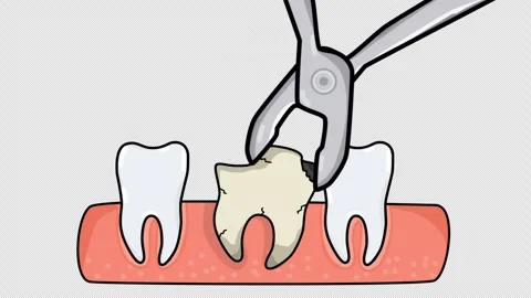 Tooth Extraction Dental Medical Animatio... | Stock Video | Pond5