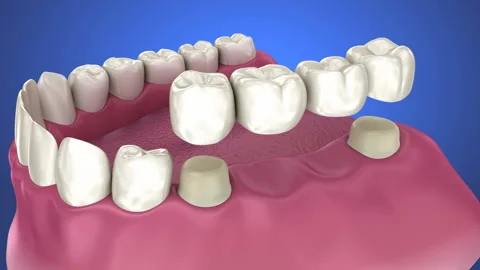 Fixed Bridge Stock Video Footage | Royalty Free Fixed Bridge Videos | Pond5