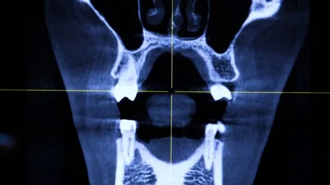 toothache symptom. X-ray of the human ja... | Stock Video | Pond5