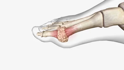 Tophaceous gout is the most severe form ... | Stock Video | Pond5