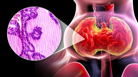 Toxic goitre of thyroid gland, 3D illust... | Stock Video | Pond5