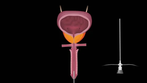 Prostate Gland Stock Footage ~ Royalty Free Stock Videos | Pond5