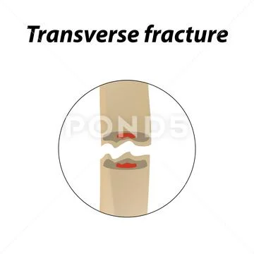 Transverse bone fracture. Infographics. Vector illustration on a lined ...