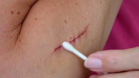 Treating a deep cut on the hand. Scar on... | Stock Video | Pond5