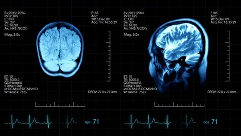 Two animated pictures of mri brain scan ... | Stock Video | Pond5