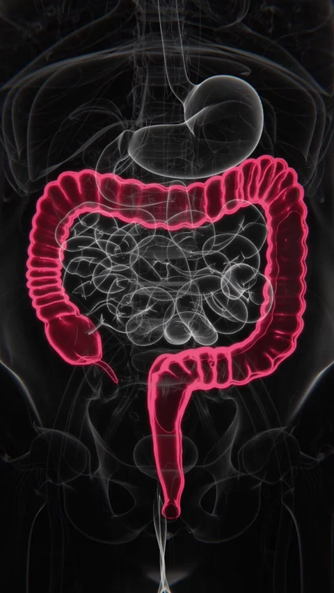 Ulcerative Colitis Indication X-ray in V... | Stock Video | Pond5