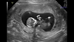 25 Weeks Pregnant Ultrasound Boy