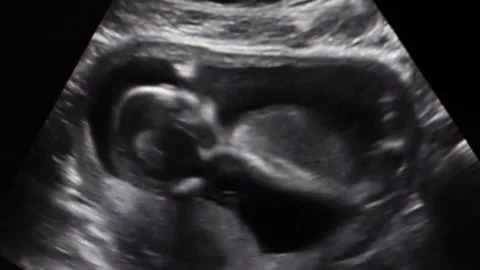 Ultrasound of baby . Human embryo moving... | Stock Video | Pond5