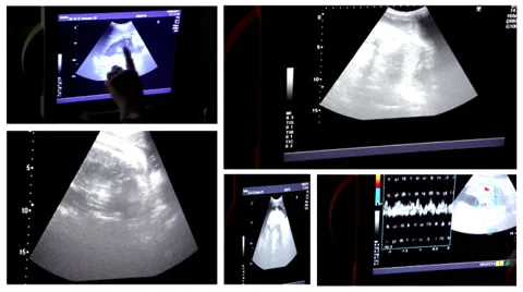 Ultrasound baby in mother's womb multi s... | Stock Video | Pond5