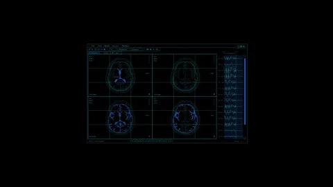 Ultrasound brain echography scan showing... | Stock Video | Pond5