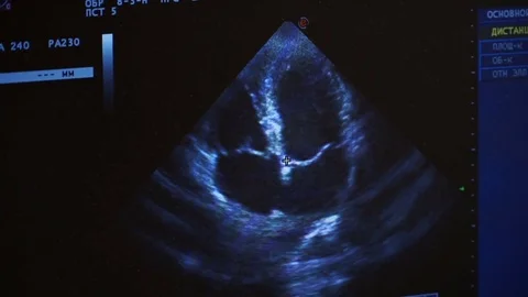 Ultrasound. Cardiology. Monitor screen c... | Stock Video | Pond5