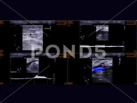 Ultrasound doppler for diagnosis deep vein thrombosis disease of lower ...