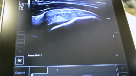 Ultrasound on monitor. Ultrasound image ... | Stock Video | Pond5