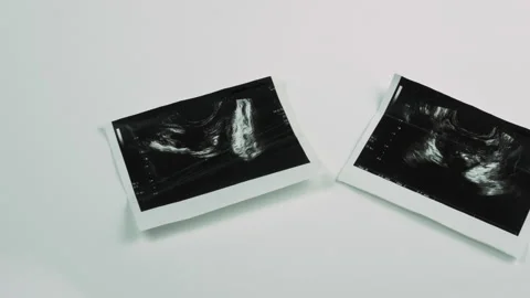 Ultrasound of the prostate on a white ba... | Stock Video | Pond5