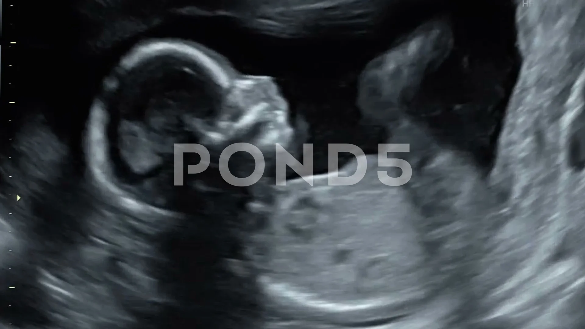 17 Weeks Pregnant Ultrasound