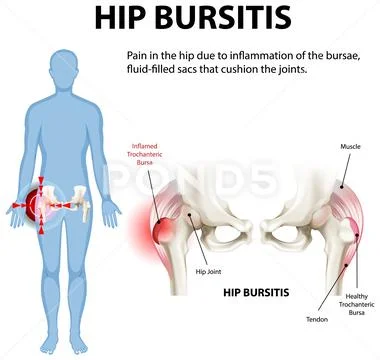 Understanding Hip Bursitis and Its Effects: Royalty Free #294492998
