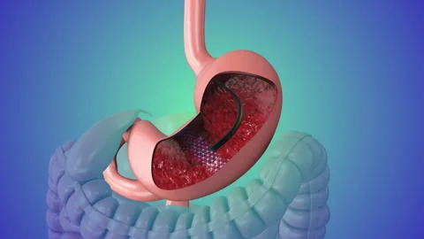 Upper gastrointestinal endoscopy medical... | Stock Video | Pond5