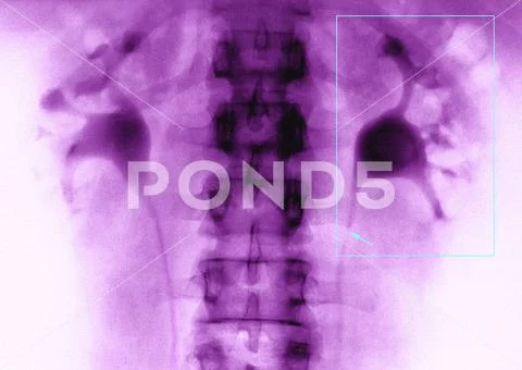 Ureteral lithiasis, x-ray Renal colic - a highly painful syndrome ...