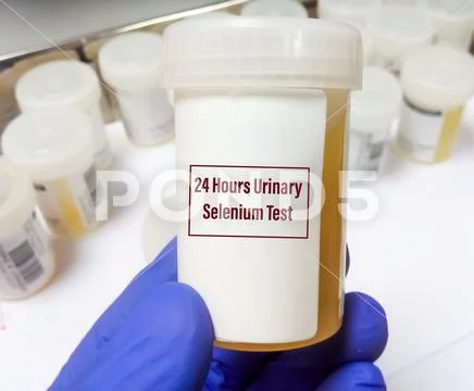 Photograph: Urine container with sample for 24 hours urinary selenium ...