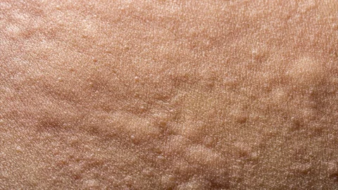 urticaria or allergy rash. dolly shot, s... | Stock Video | Pond5