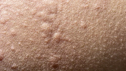 urticaria or allergy rash. dolly shot, s... | Stock Video | Pond5