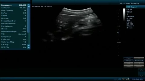 USG Abdomen Screen record | Stock Video | Pond5