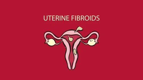 UTERINE FIBROIDS VIDEO Female Reproducti... | Stock Video | Pond5