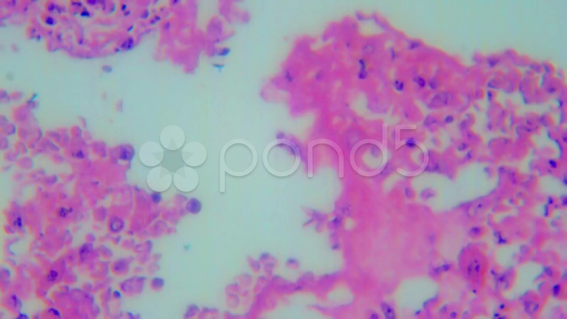 Tuberculosis Human Lungs