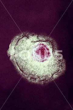 Varicella zoster virus Electron micrograph of a Varicella (Chickenpox ...