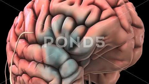 The vein to the brain is blocked and brain hemorrhage occurs ...