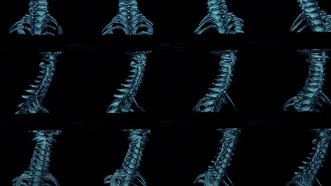 Vertebral column, Spine, MRI Scan | Stock Video | Pond5
