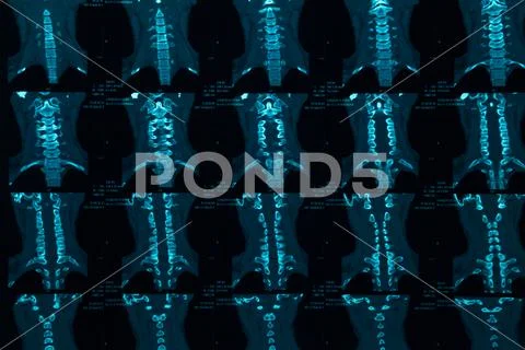 Photograph: Vertebral column, Spine, MRI Scan, Human Body Xray Monitor ...